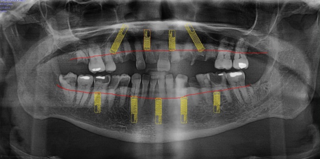 Overcoming obstacles using the All-on-Four™ technique and fixed hybrids ...