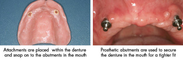 Full Arch Teeth Replacement | Dr. Caplanis